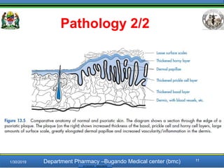 Psoriasis | PPTX