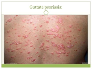 Psoriasis | PPTX