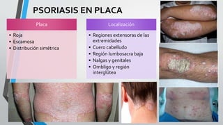 Psoriasis | PPTX