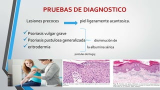 Psoriasis | PPTX