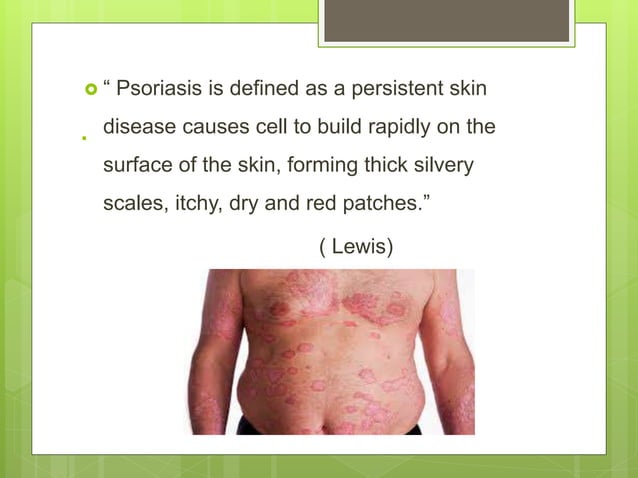 Psoriasis | PPTX