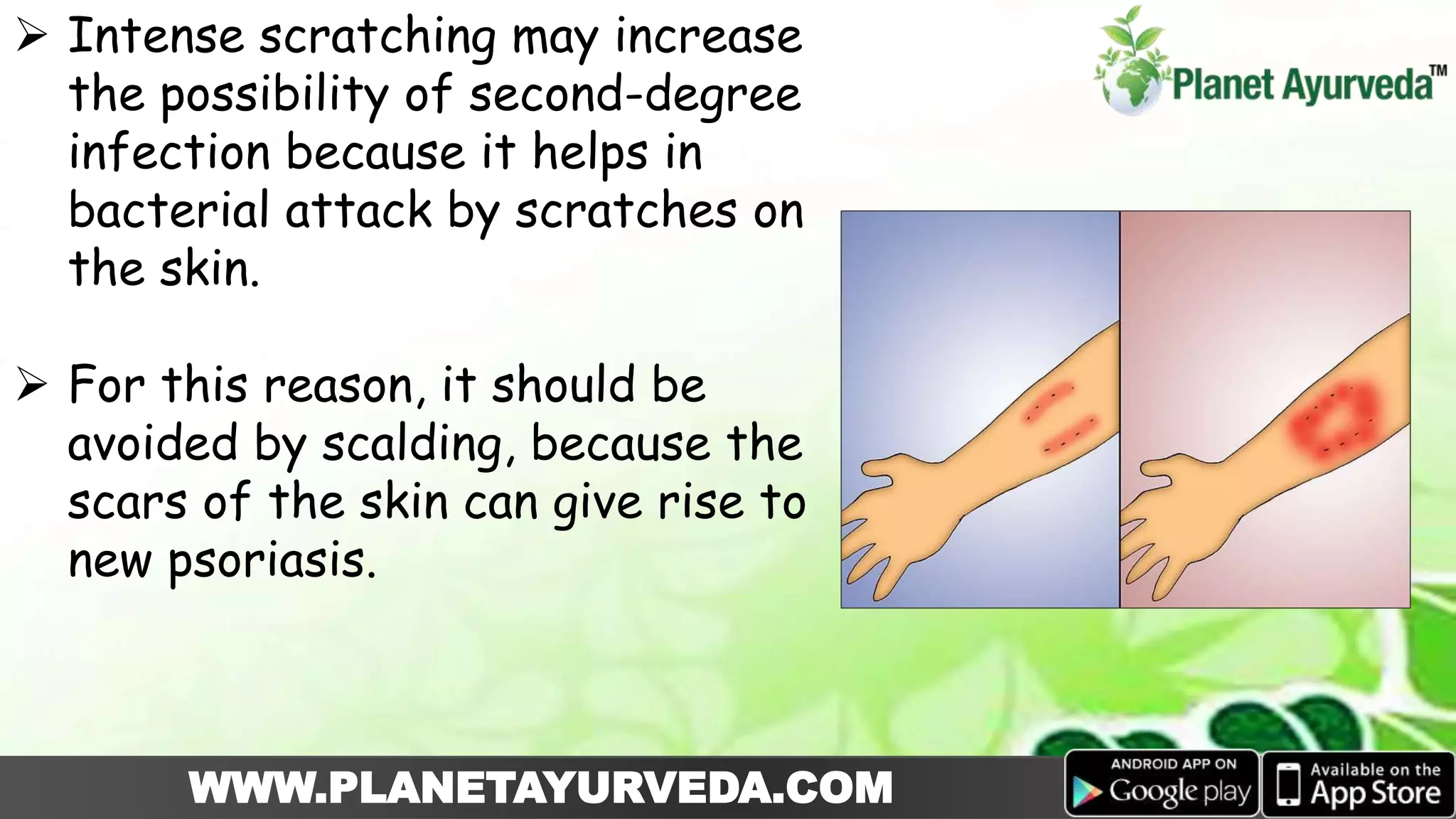 PSORIASIS - Frequently Asked Questions & Answers | PPTX