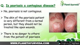 PSORIASIS - Frequently Asked Questions & Answers | PPTX