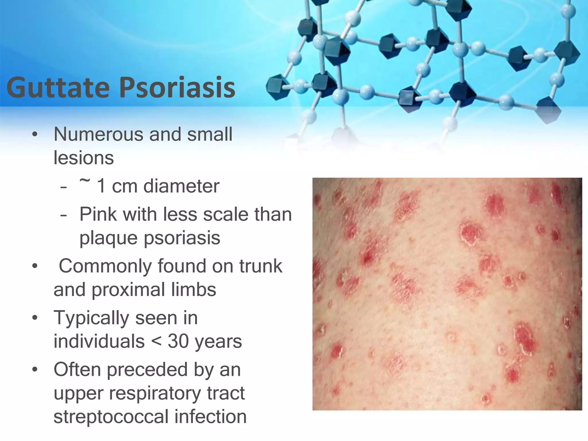 Psoriasis: Diagnosis and Management | PPTX