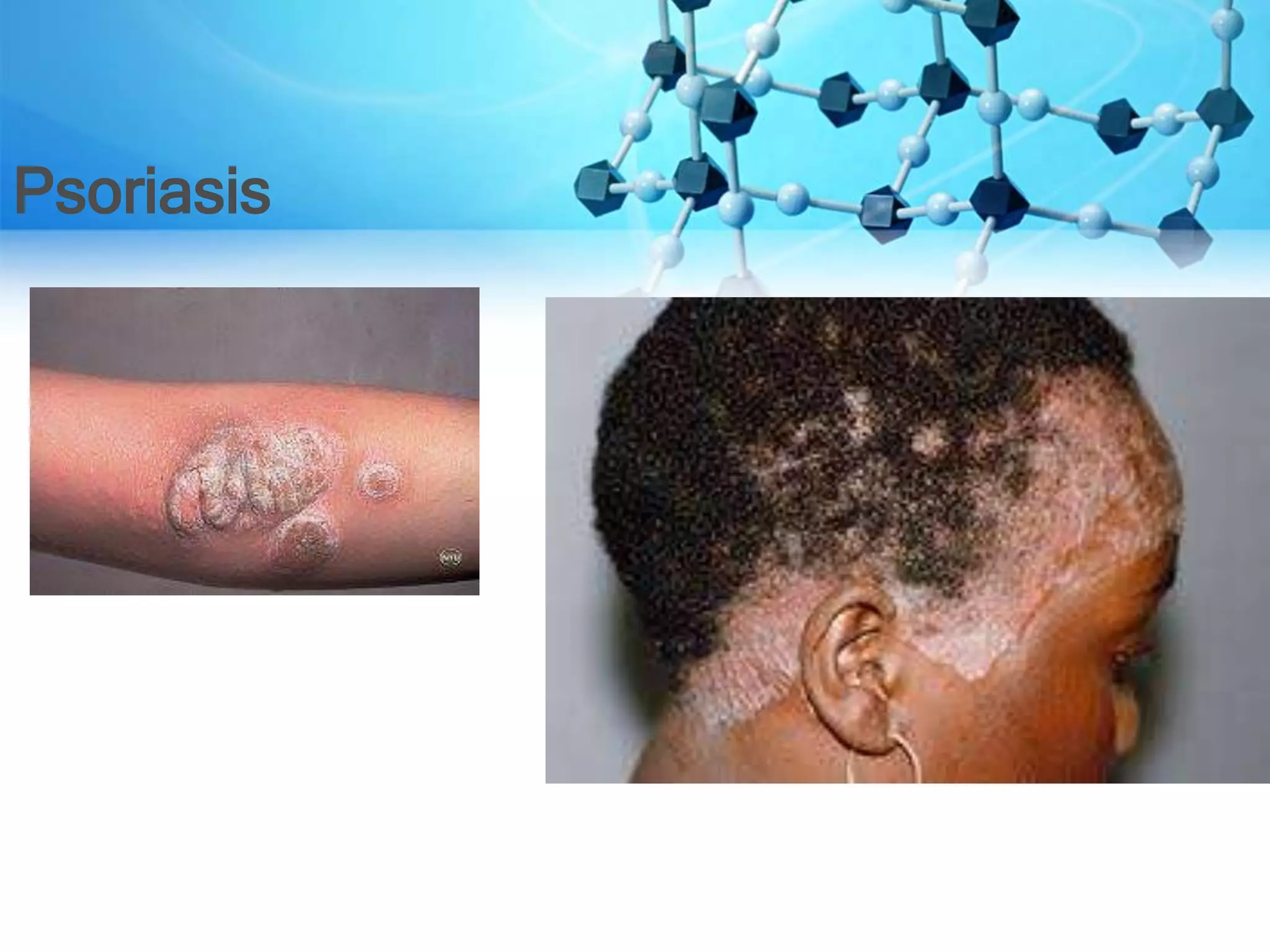 Psoriasis: Diagnosis and Management | PPTX