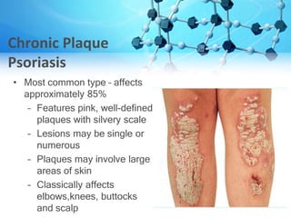 Psoriasis: Diagnosis and Management | PPTX