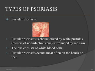 Psoriasis | PPTX