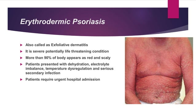 Psoriasis | PPTX | Skin and Dermatology | Diseases and Conditions