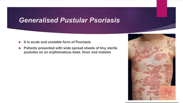 Psoriasis | PPTX | Skin and Dermatology | Diseases and Conditions