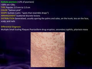 Psoriasis | PPTX