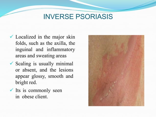 Psoriasis | PPTX | Skin and Dermatology | Diseases and Conditions