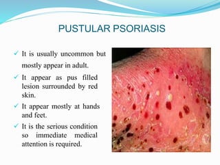 Psoriasis | PPTX
