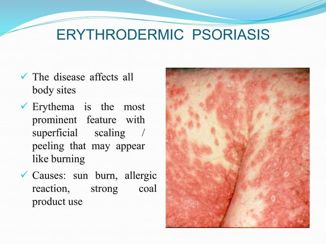 Psoriasis | PPTX | Skin and Dermatology | Diseases and Conditions