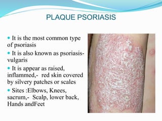Psoriasis | PPTX