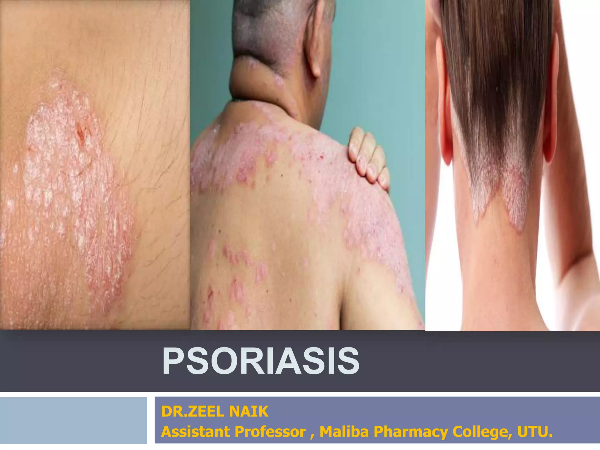 Psoriasis | PPTX | Skin and Dermatology | Diseases and Conditions