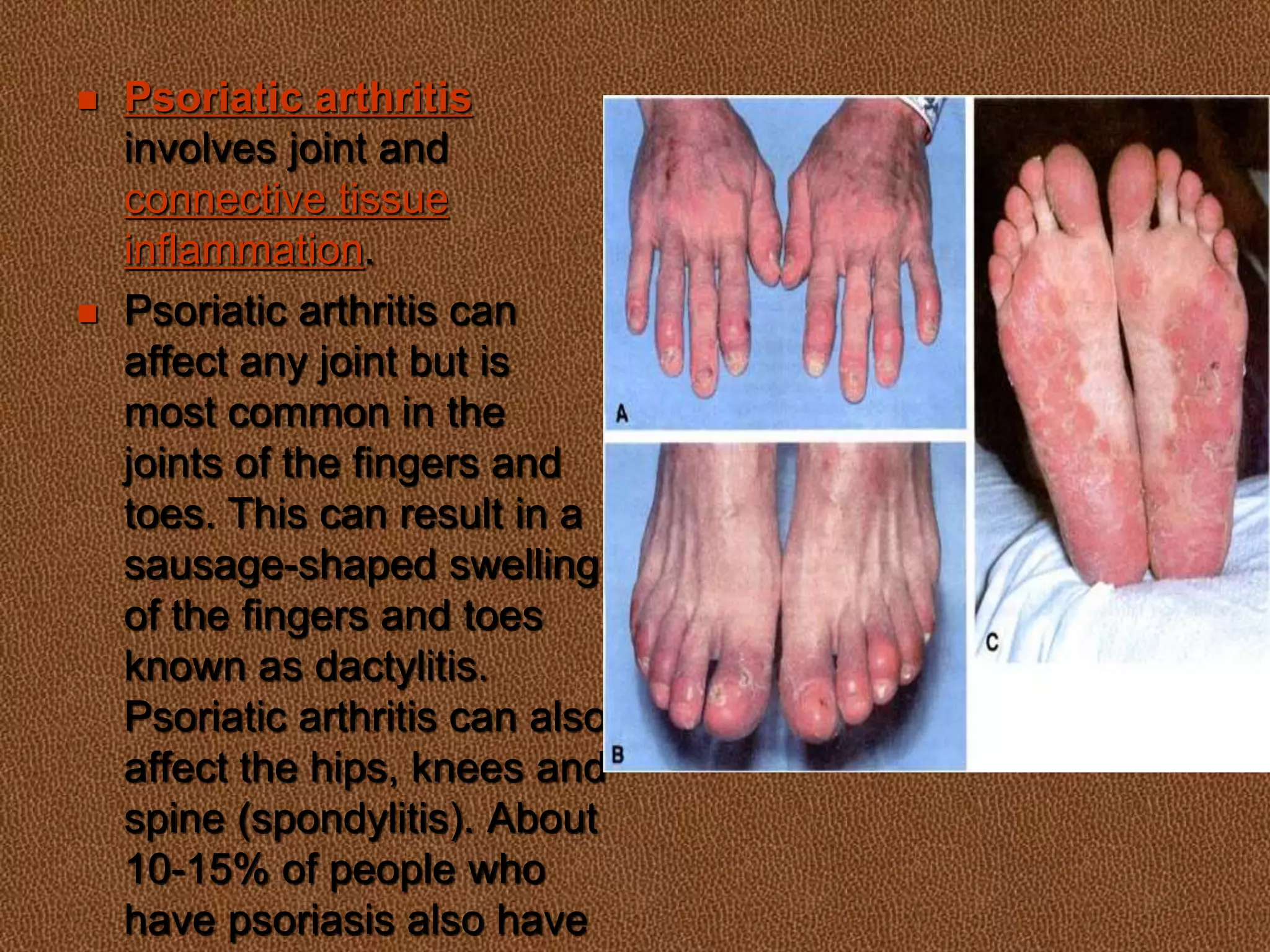 Psoriasis skin disease dermatology | PPT