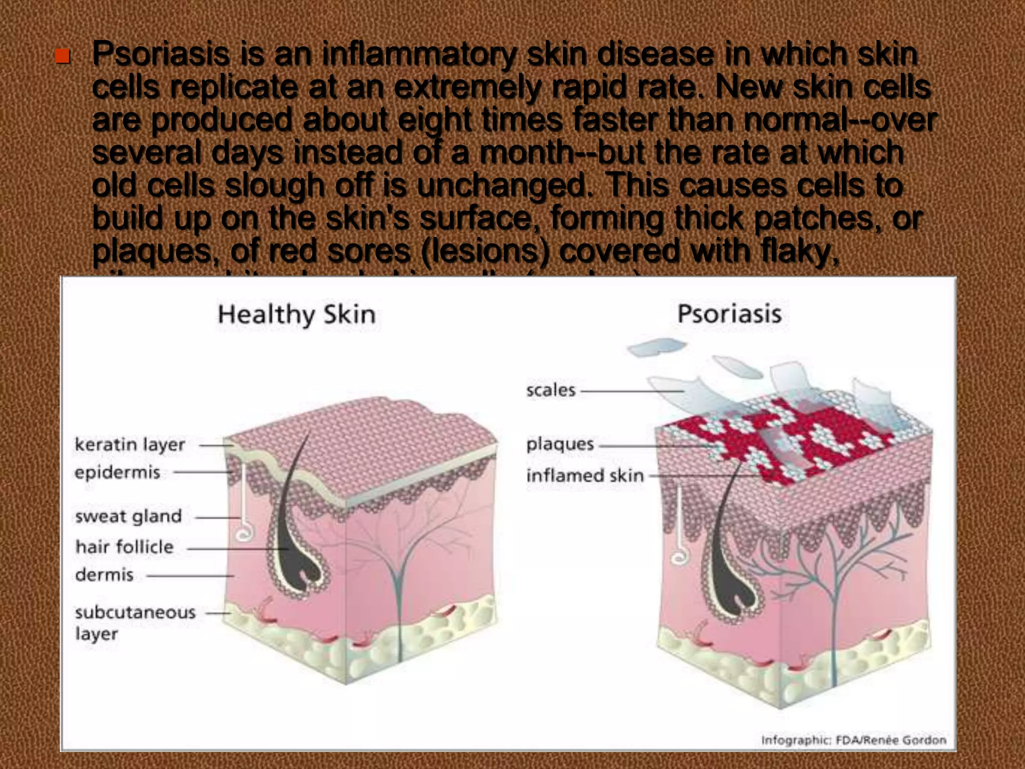 Psoriasis skin disease dermatology | PPT