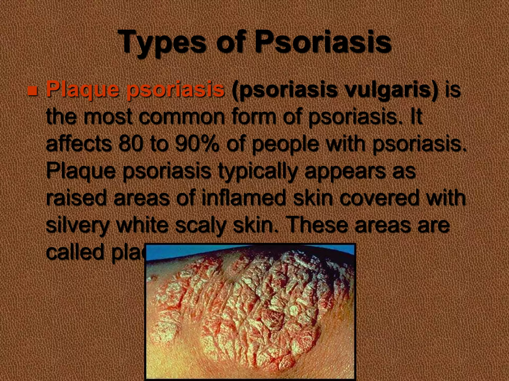 Psoriasis skin disease dermatology | PPT