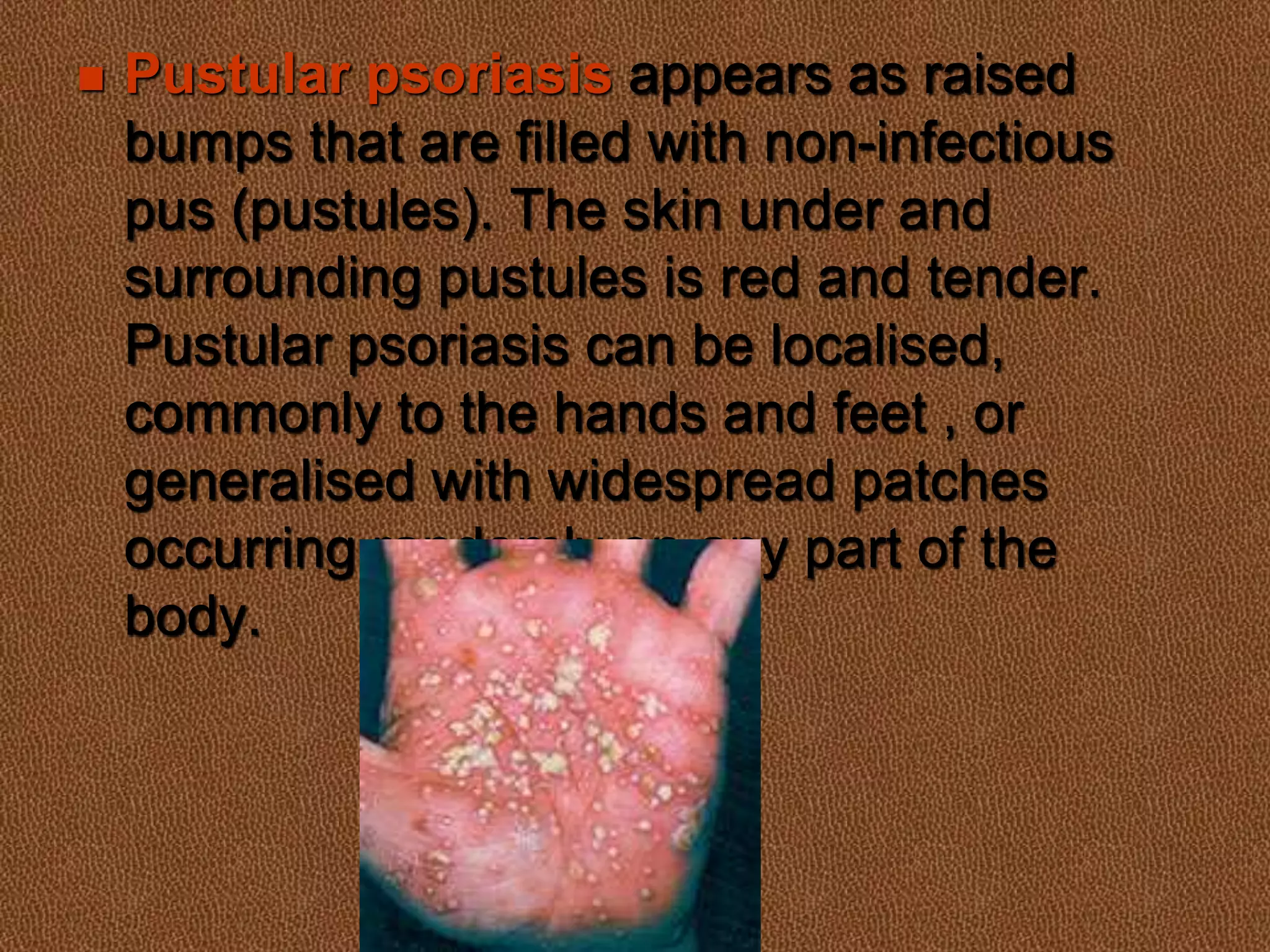 Psoriasis skin disease dermatology | PPT