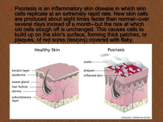 Psoriasis skin disease dermatology | PPT | Skin and Dermatology ...