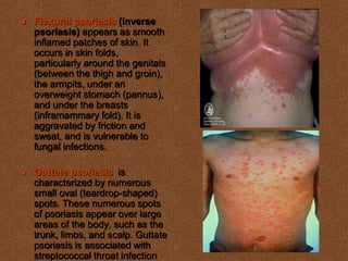 Psoriasis skin disease dermatology | PPT