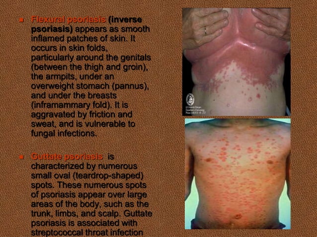 Psoriasis skin disease dermatology | PPT | Skin and Dermatology ...