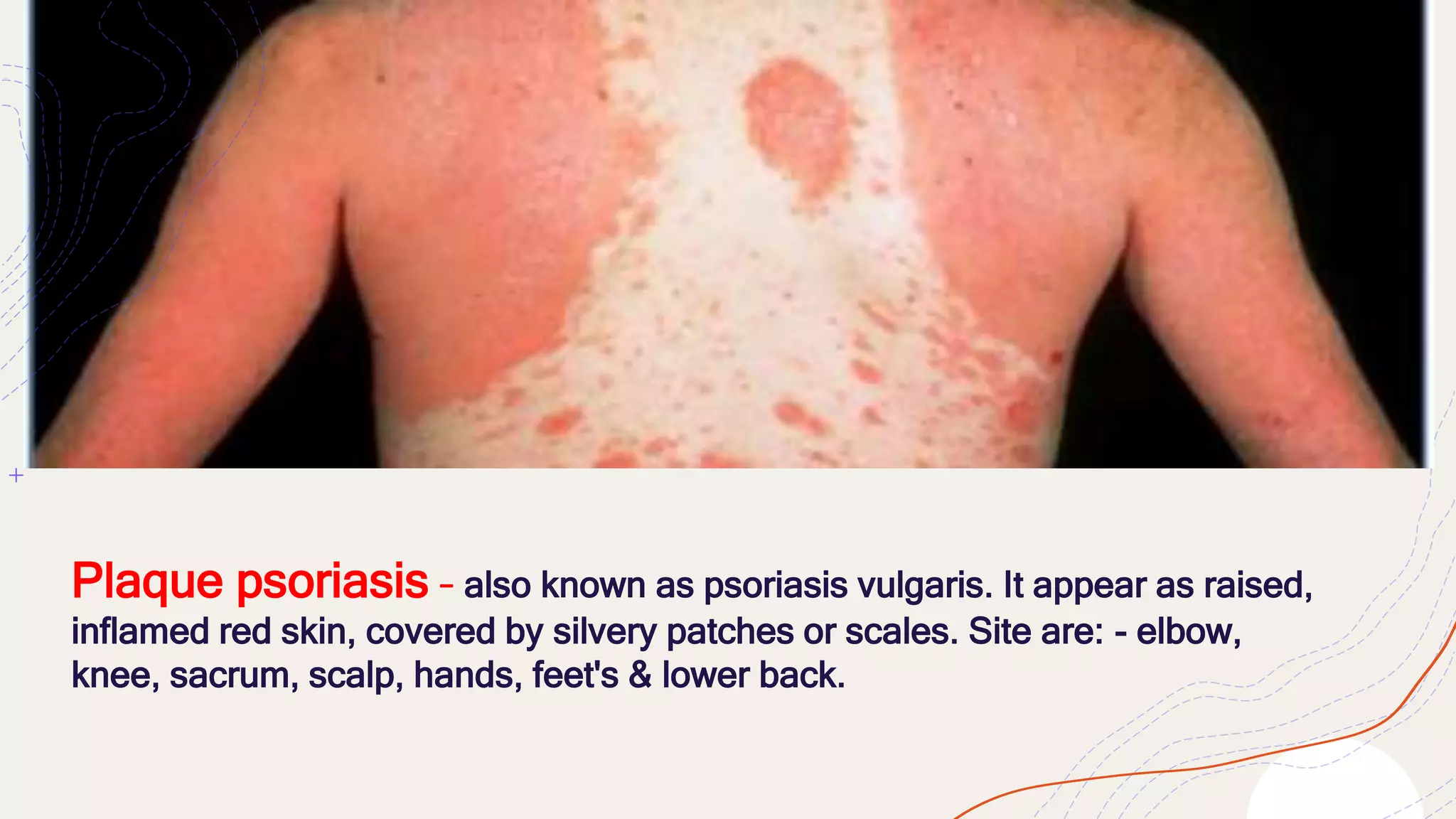 Psoriasis | PPTX