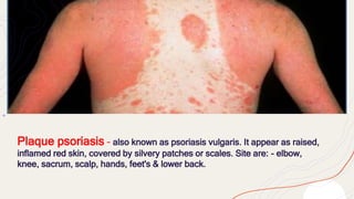 Psoriasis | PPTX