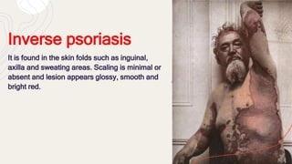 Psoriasis | PPTX