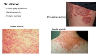 Psoriasis | PPTX