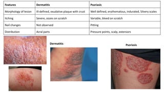Psoriasis | PPT