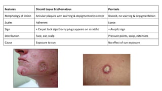 Psoriasis | PPT
