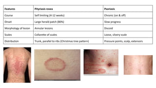 Psoriasis | PPT