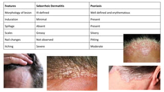 Psoriasis | PPT