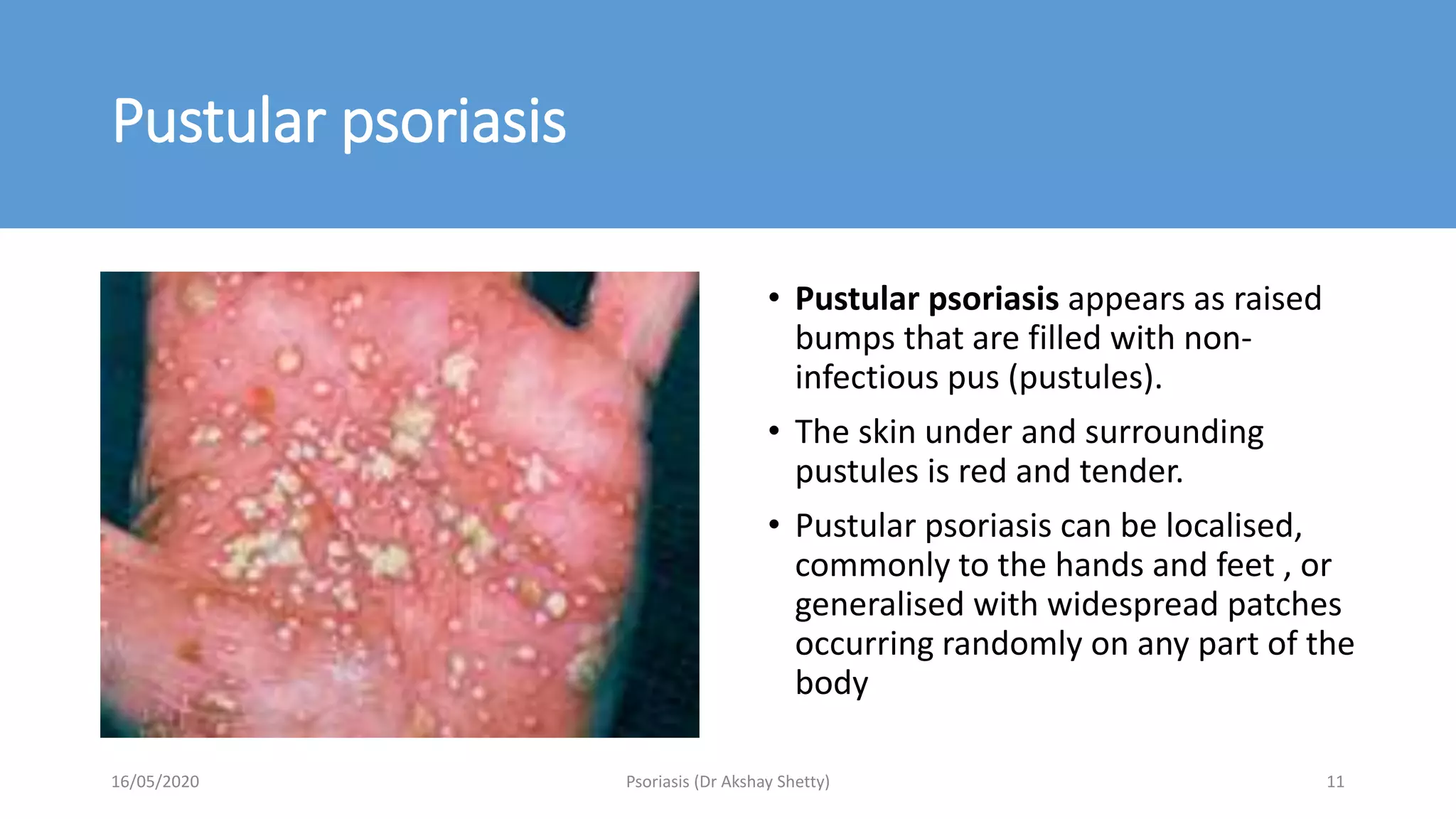 Psoriasis | PPTX
