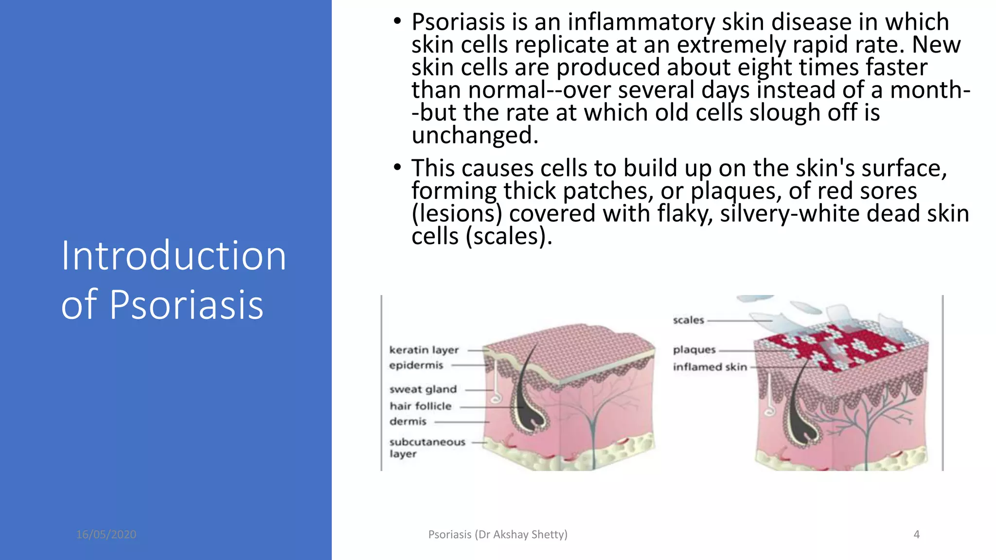 Psoriasis | PPTX