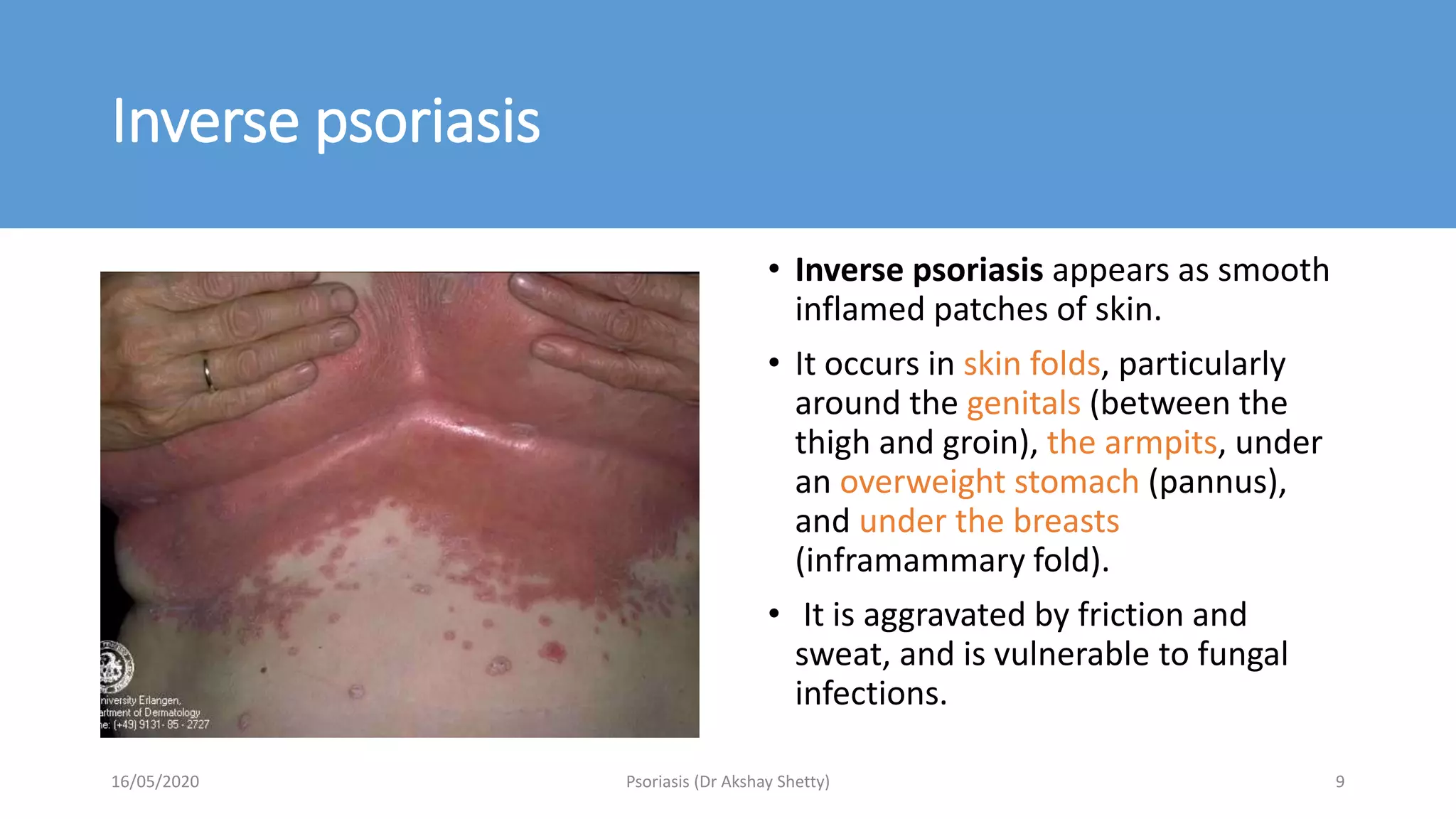 Psoriasis | PPTX