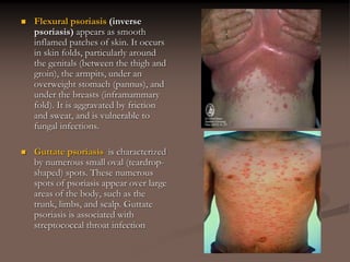 psoriasis.ppt