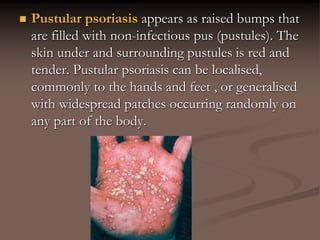 psoriasis.ppt