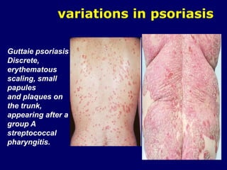 Psoriasis.pdf | Skin and Dermatology | Diseases and Conditions