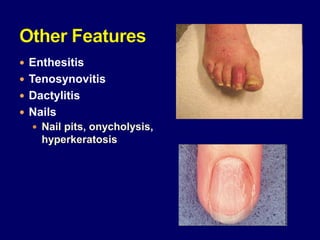 Psoriasis.pdf | Skin and Dermatology | Diseases and Conditions