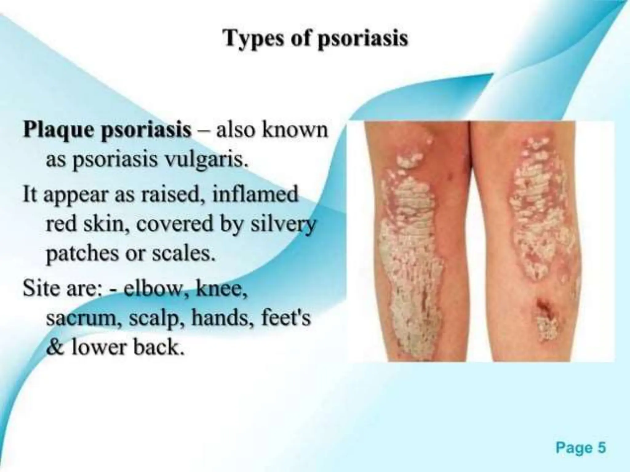 psoriasis.pptx
