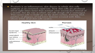 Psoriasis (Dermatological diseases) pptx | PPTX