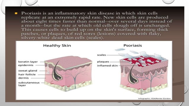 Psoriasis (Dermatological diseases) pptx | PPTX | Skin and Dermatology | Diseases and Conditions