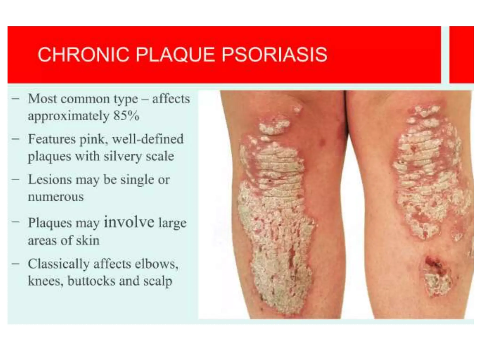 Clinical Pharmacotherapy of Psoriasis Disease | PPTX
