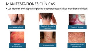 Clase de psoriasis para curso de podologia clinica | PPTX