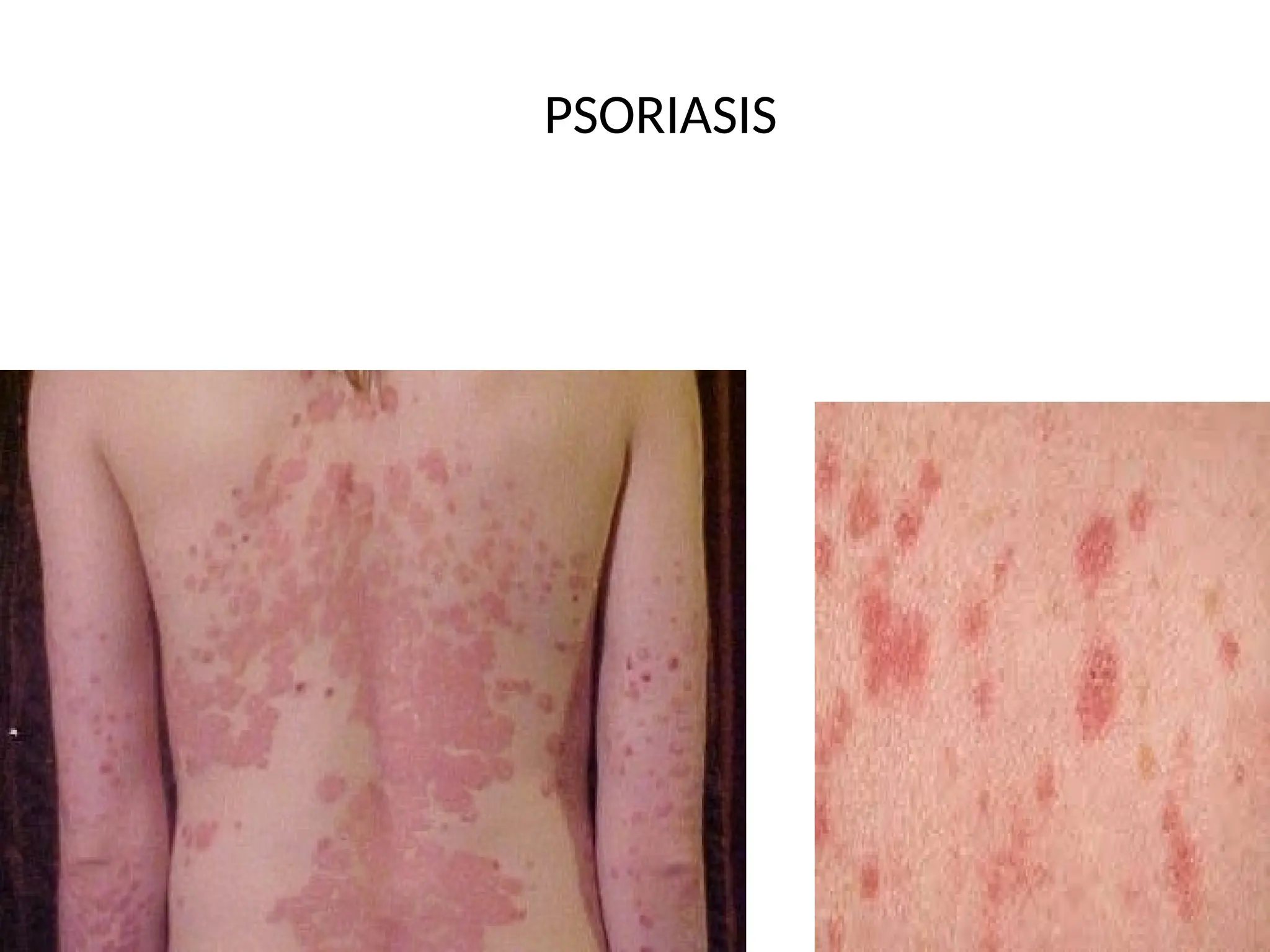 PSORIASIS PRESENTATION FOR EDUCATION.pptx | Skin and Dermatology | Diseases and Conditions
