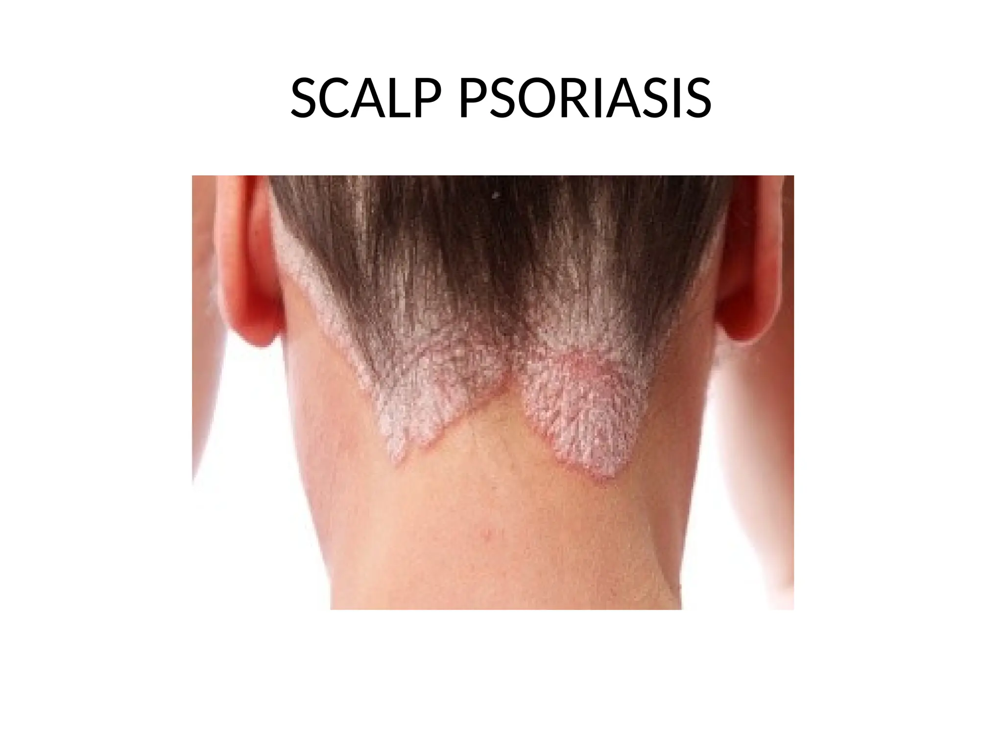 PSORIASIS PRESENTATION FOR EDUCATION.pptx | Skin and Dermatology ...