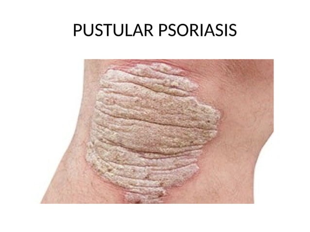 PSORIASIS PRESENTATION FOR EDUCATION.pptx | Skin and Dermatology ...