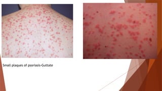 PSORIASIS dermatology slides for medical students | PPTX